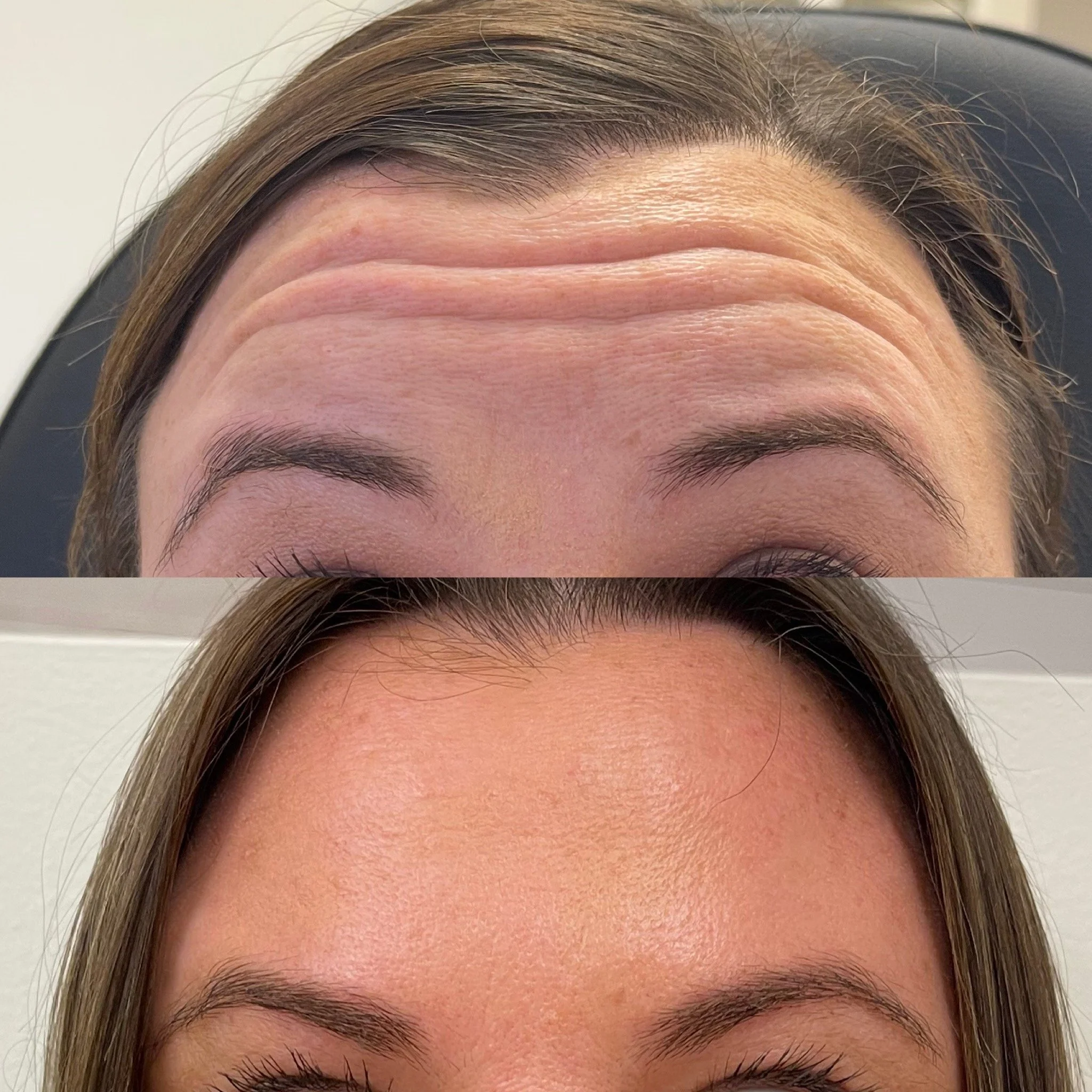 Before & Afters — Beverly Botox Nurse