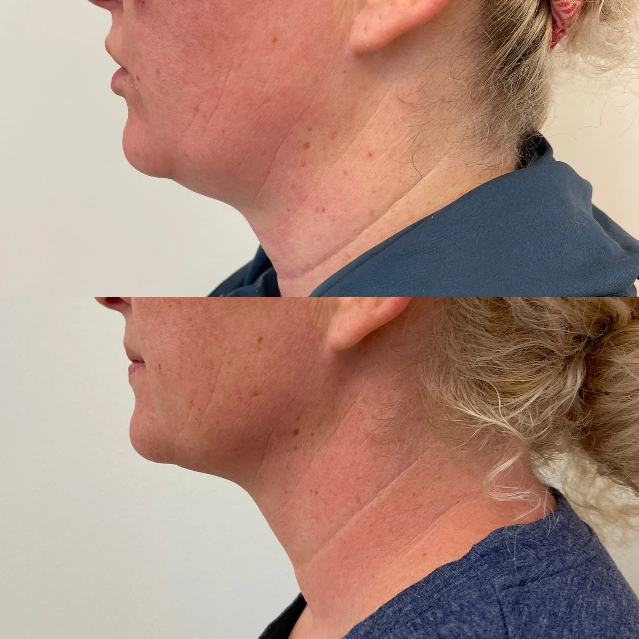 Before & Afters — Beverly Botox Nurse