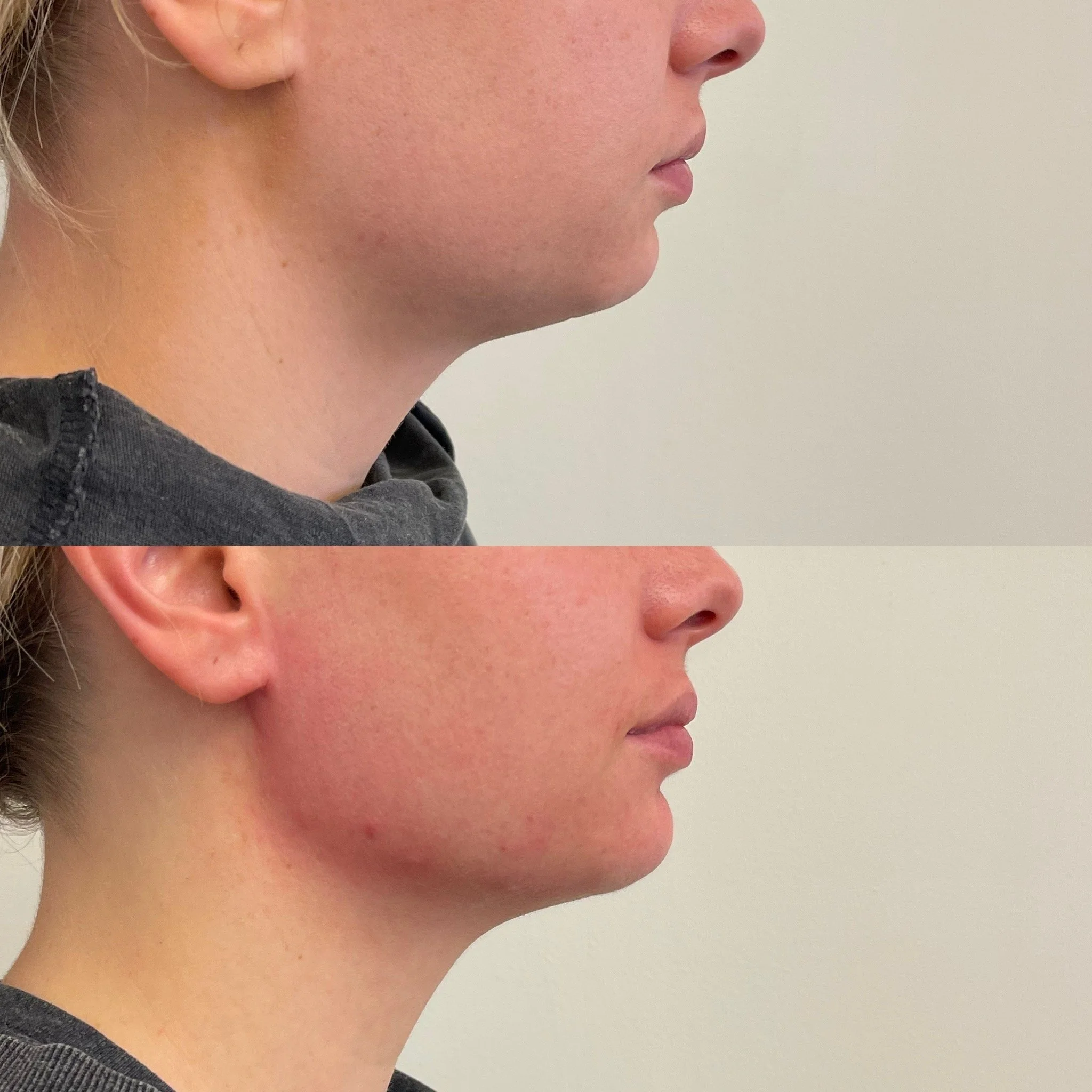 Before & Afters — Beverly Botox Nurse