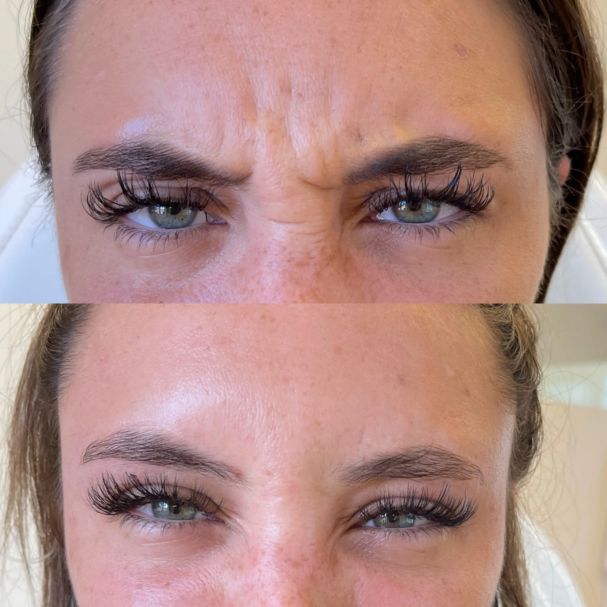 Before & Afters — Beverly Botox Nurse