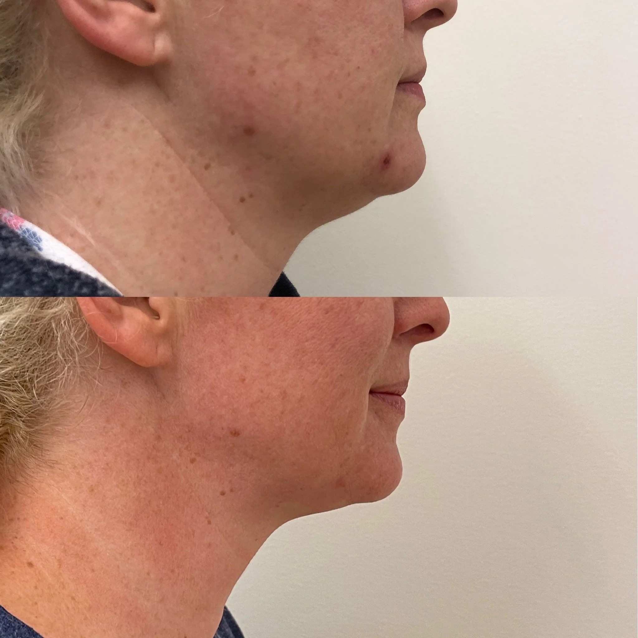 Before & Afters — Beverly Botox Nurse