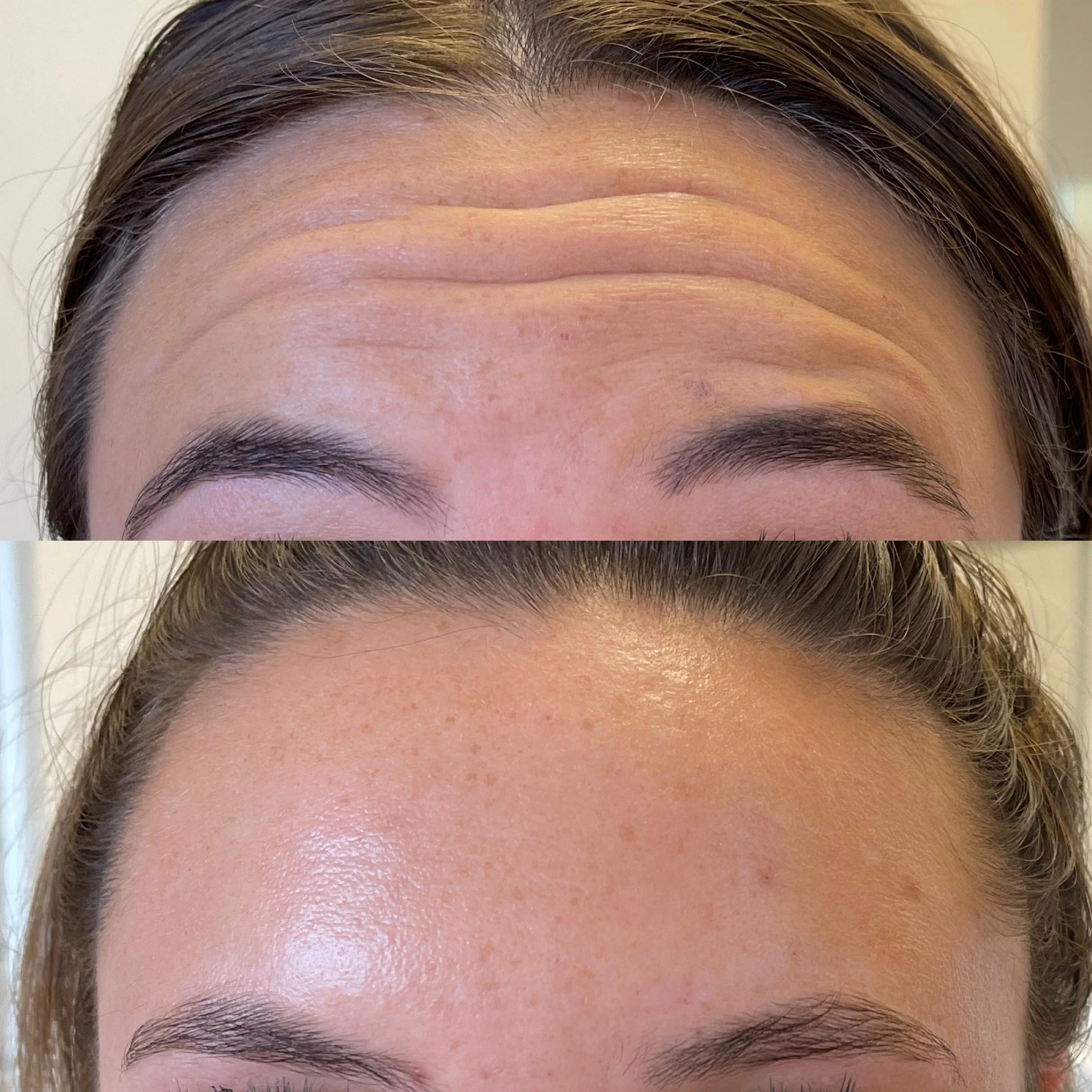 Before & Afters — Beverly Botox Nurse