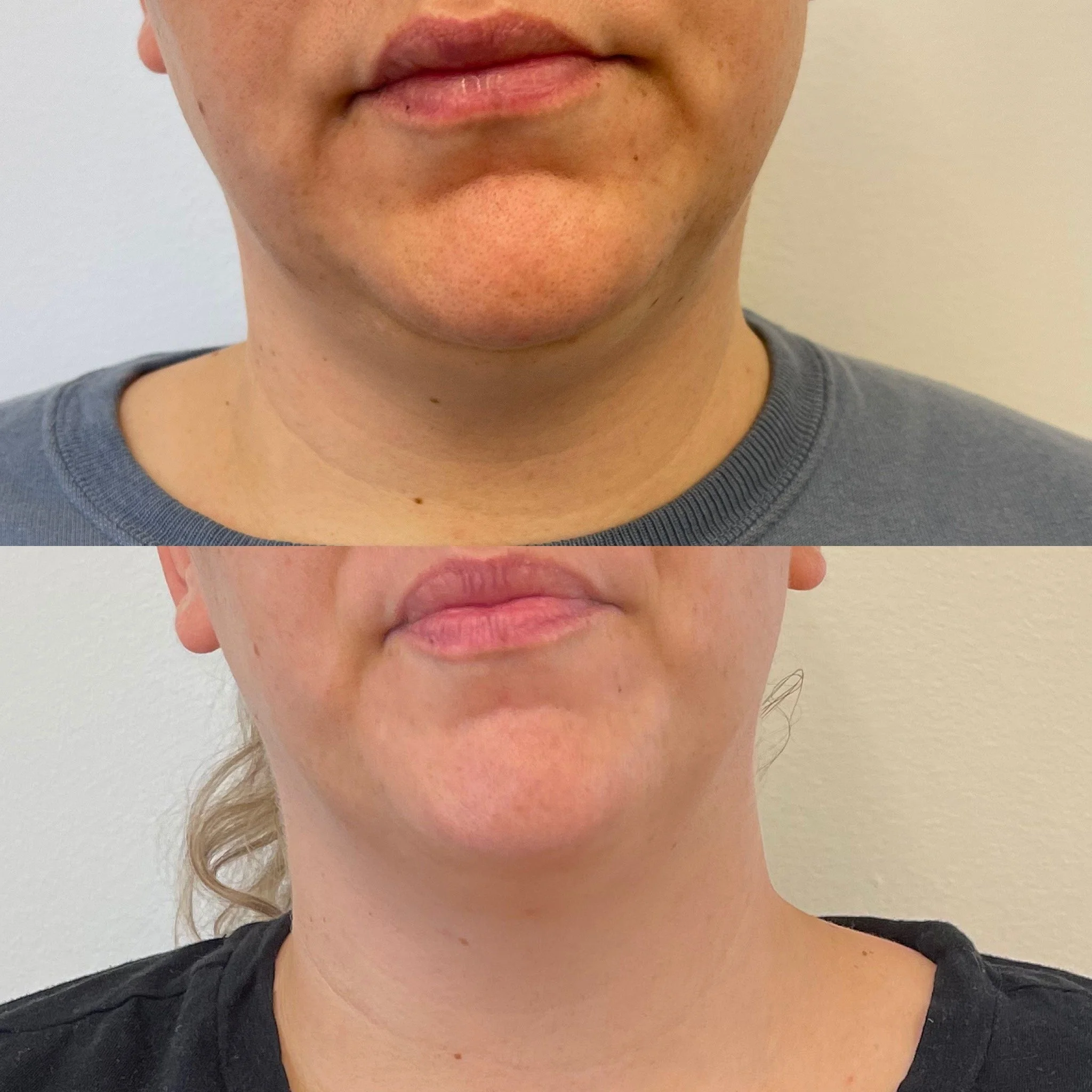 Before & Afters — Beverly Botox Nurse