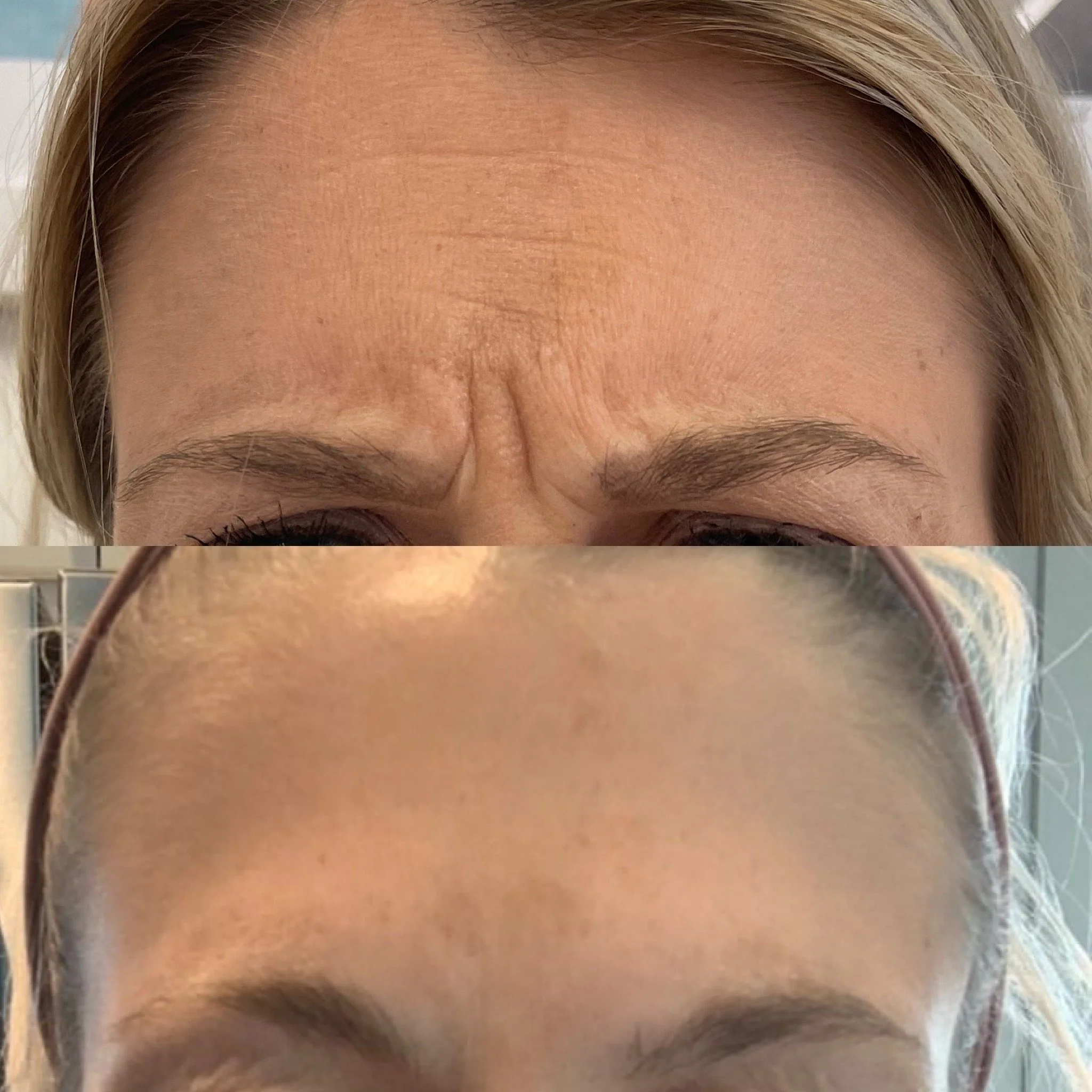 Before & Afters — Beverly Botox Nurse