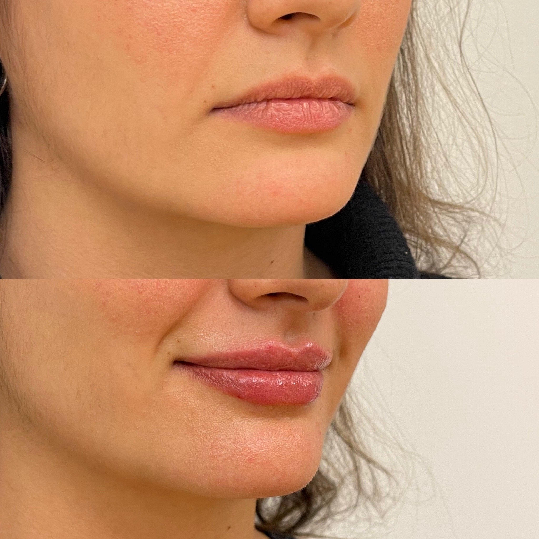 Before & Afters — Beverly Botox Nurse