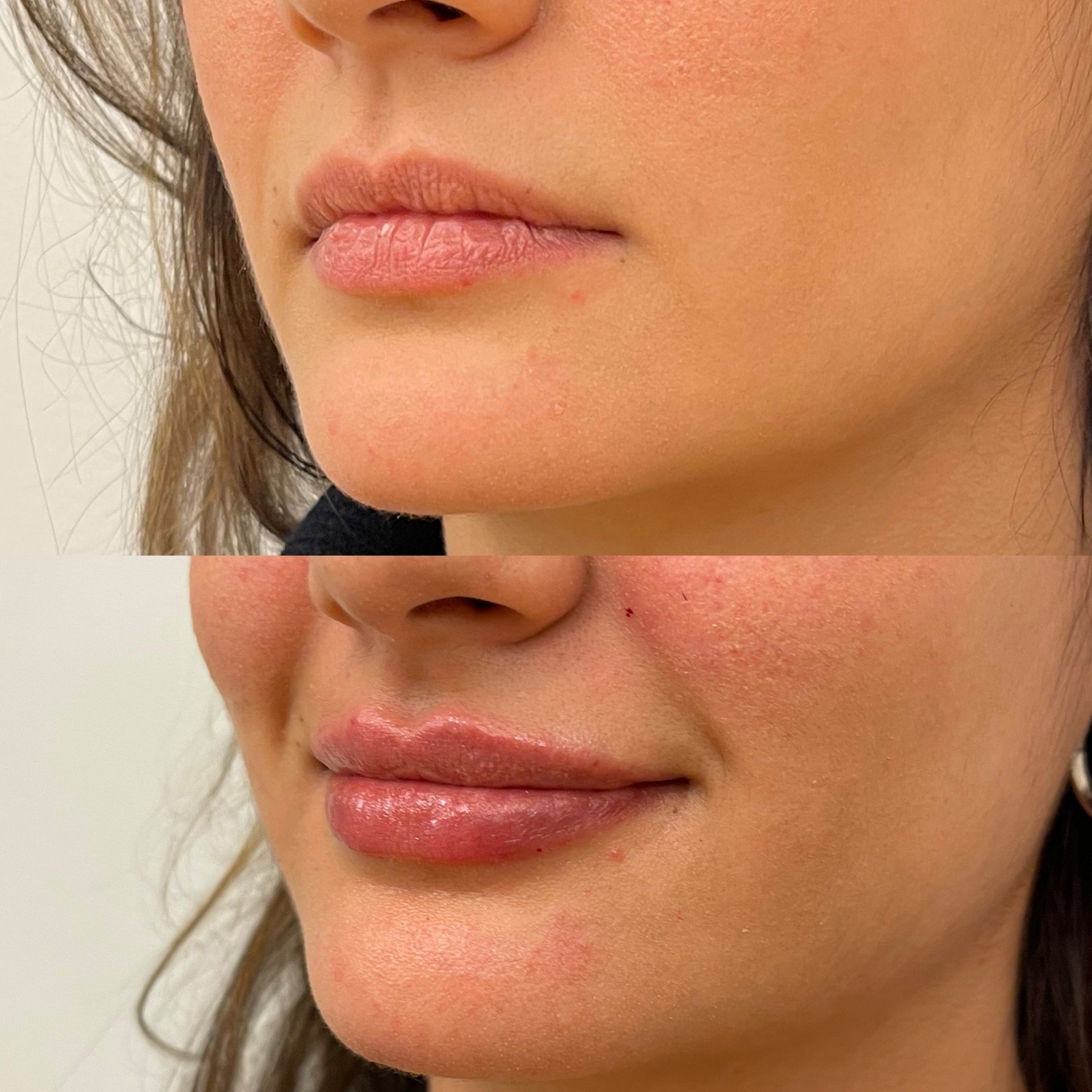 Before & Afters — Beverly Botox Nurse