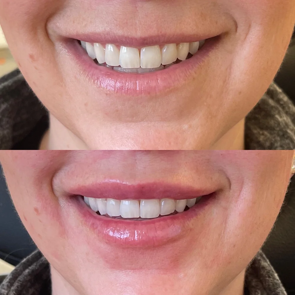 Before & Afters — Beverly Botox Nurse