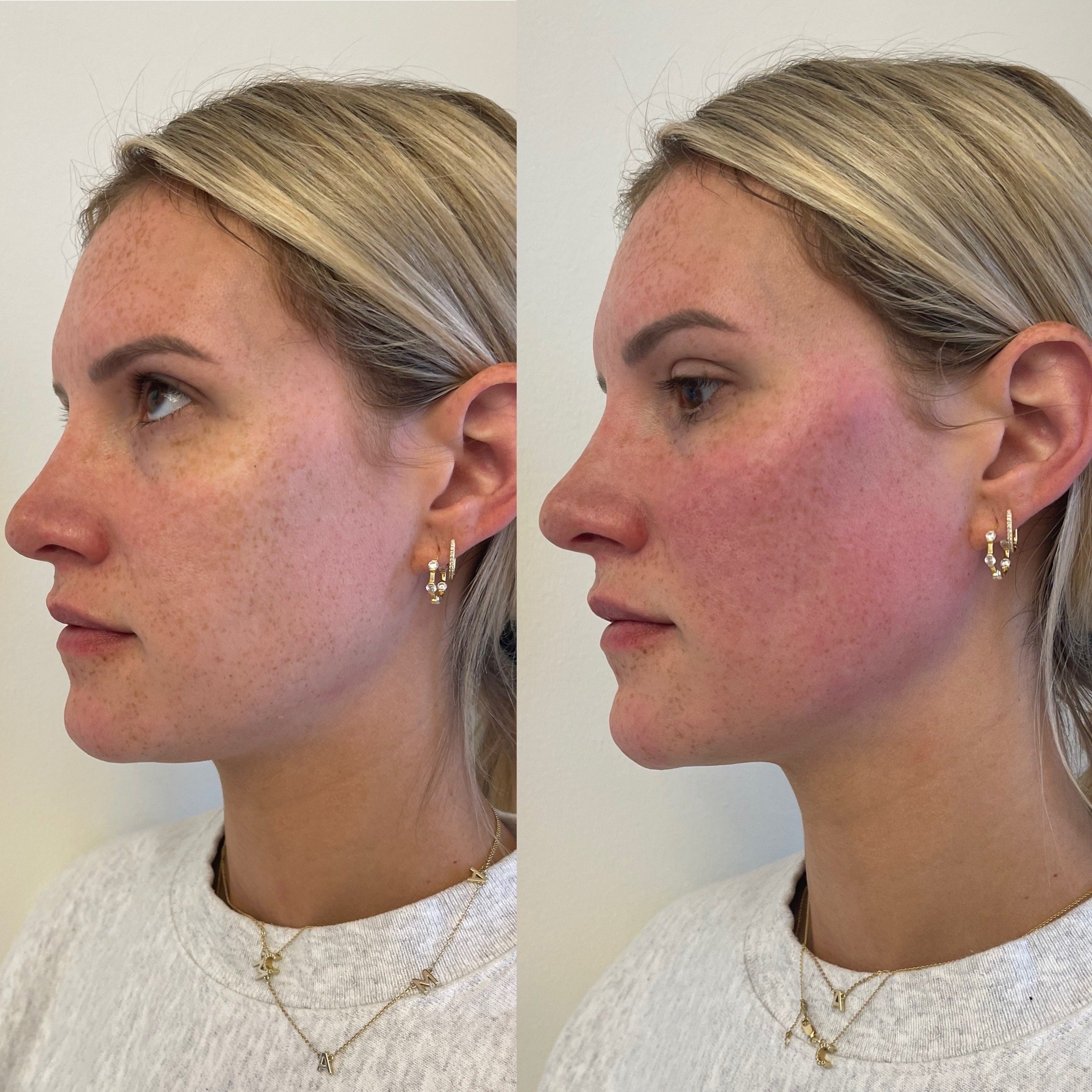 Before & Afters — Beverly Botox Nurse