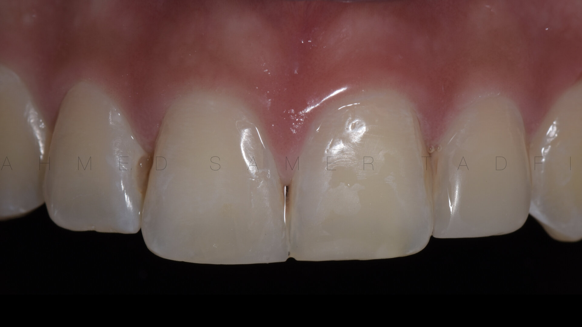 Composite Bonding in London Victoria | McKennell Dental Practice ...