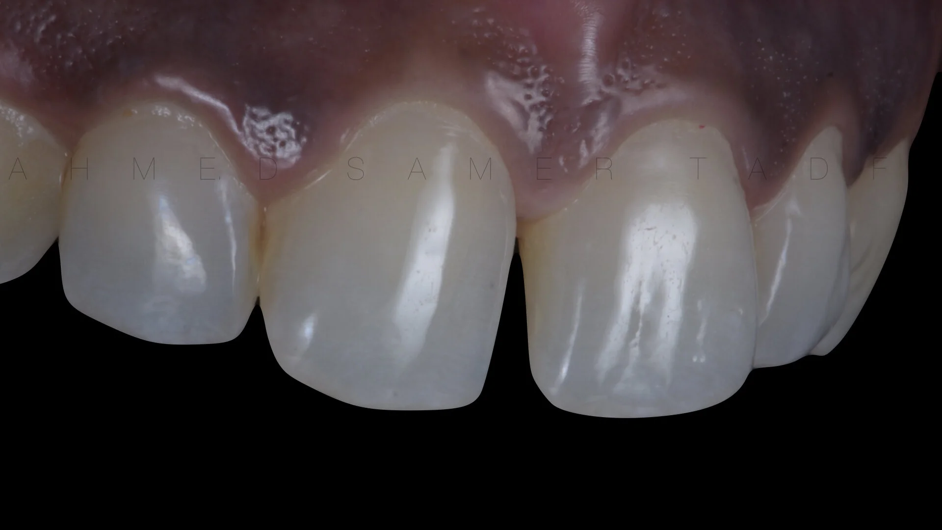 Composite Bonding in London Victoria | McKennell Dental Practice ...