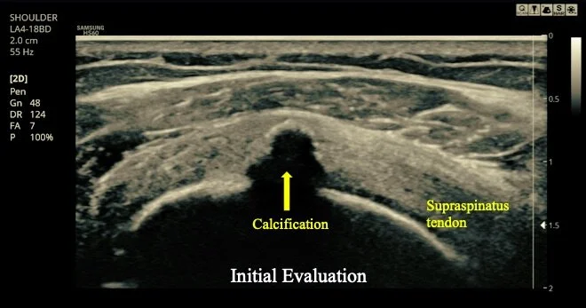 Calcific Tendinopathy — Dr. Efren Caballes, D.O.