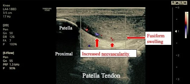 Chronic Tendinopathy — Dr. Efren Caballes, D.O.
