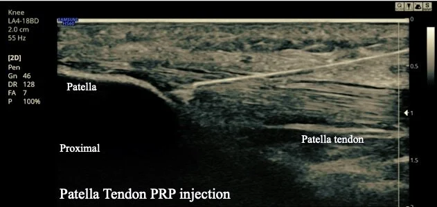 PRP Research — Dr. Efren Caballes, D.O.