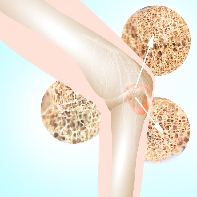 OSAplex MK-7: A Comprehensive Approach to Optimal Bone Health