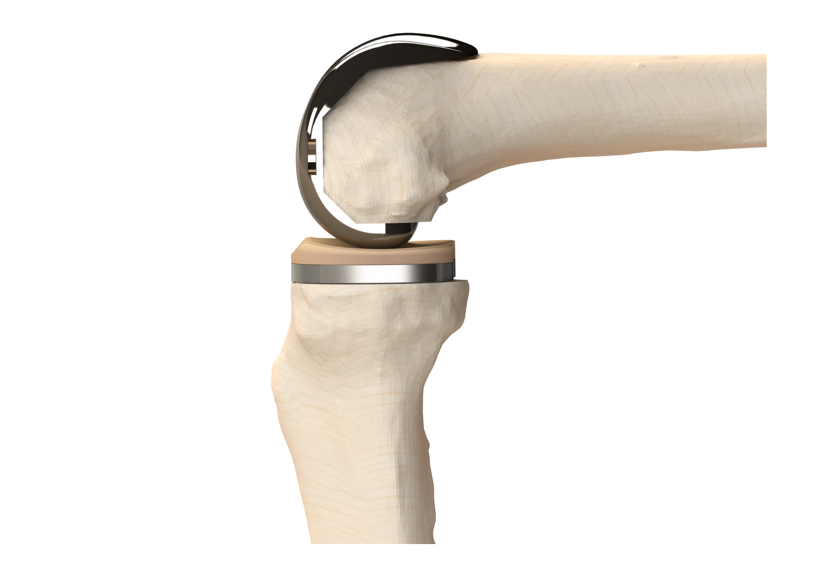 Applied Orthopedic Design - Nano Knee, Knee Replacement — AOD | Applied ...
