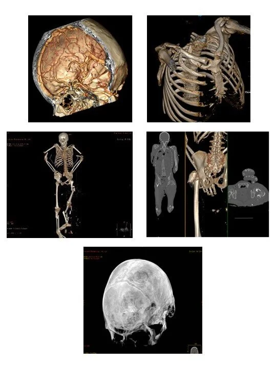 What is Post-Mortem CT? — ADS