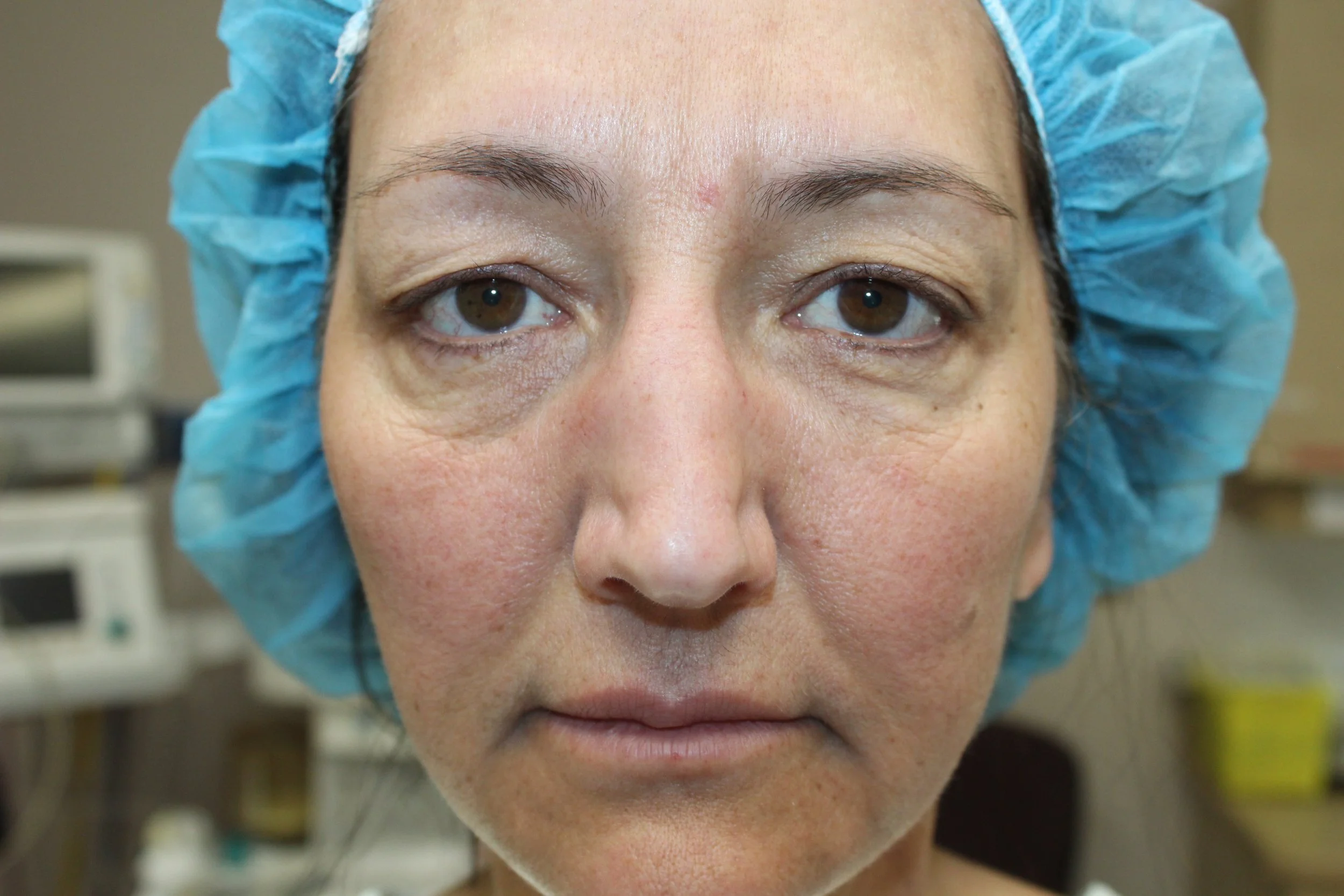 Patient T - Pre-Operative Upper Eyelids — Dr Giuffre Plastic Surgeon Edmonton