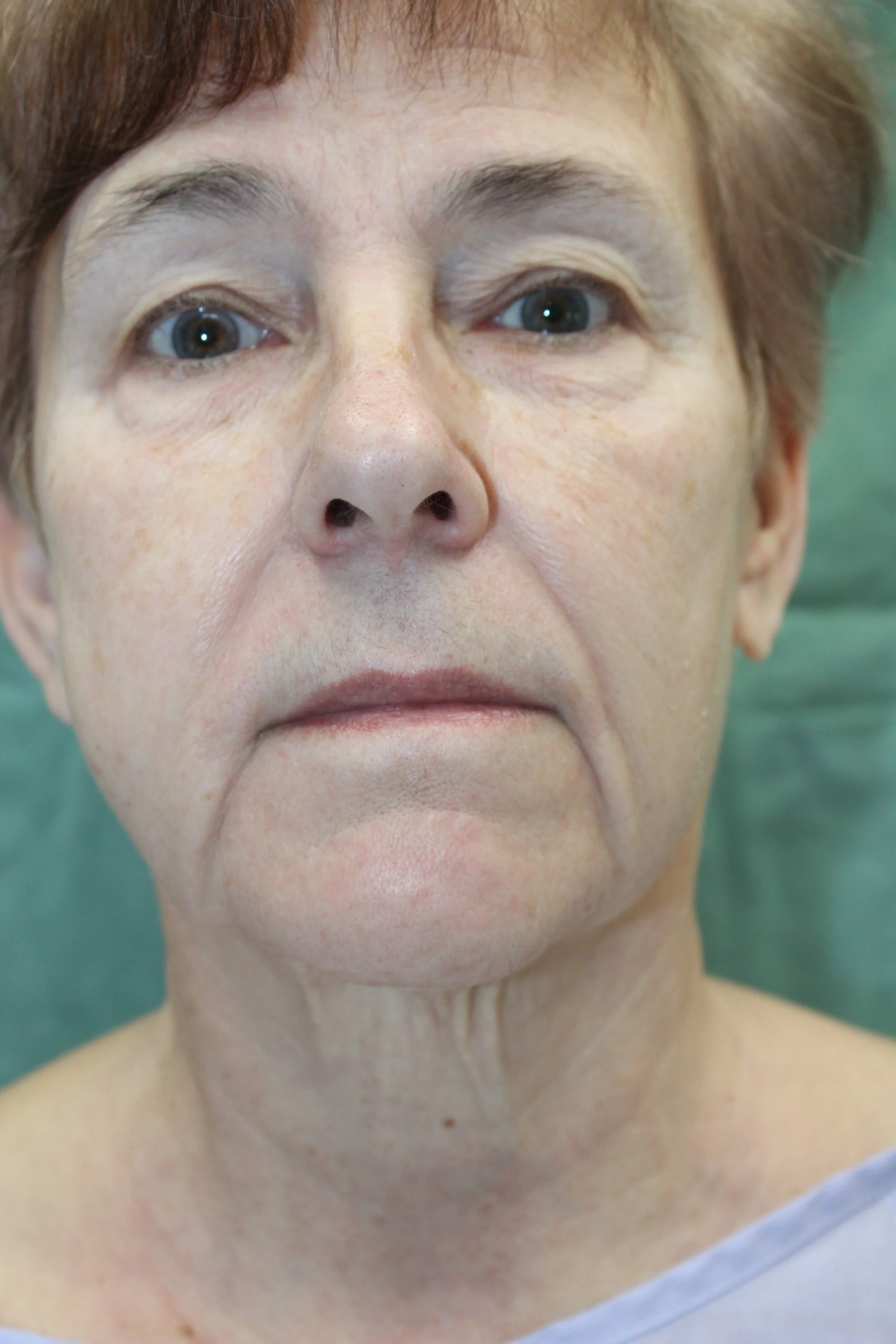 Patient R - Pre-Operative Lower Eyelids and Facelift — Dr Giuffre ...