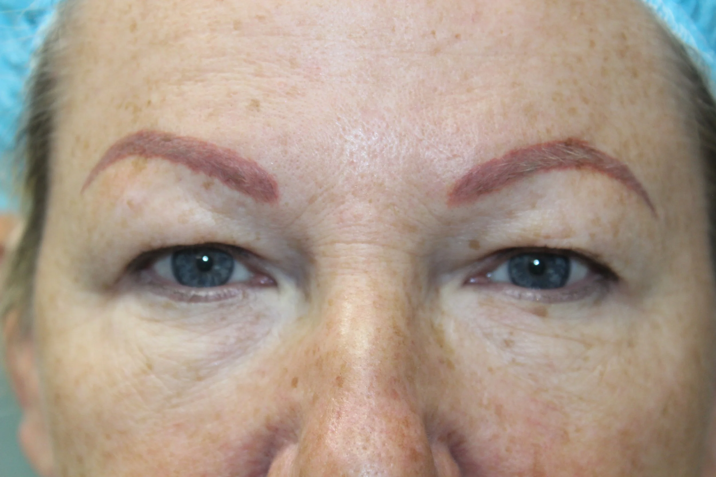 Patient S - Pre-Operative Lower Eyelids and Facelift — Dr Giuffre ...