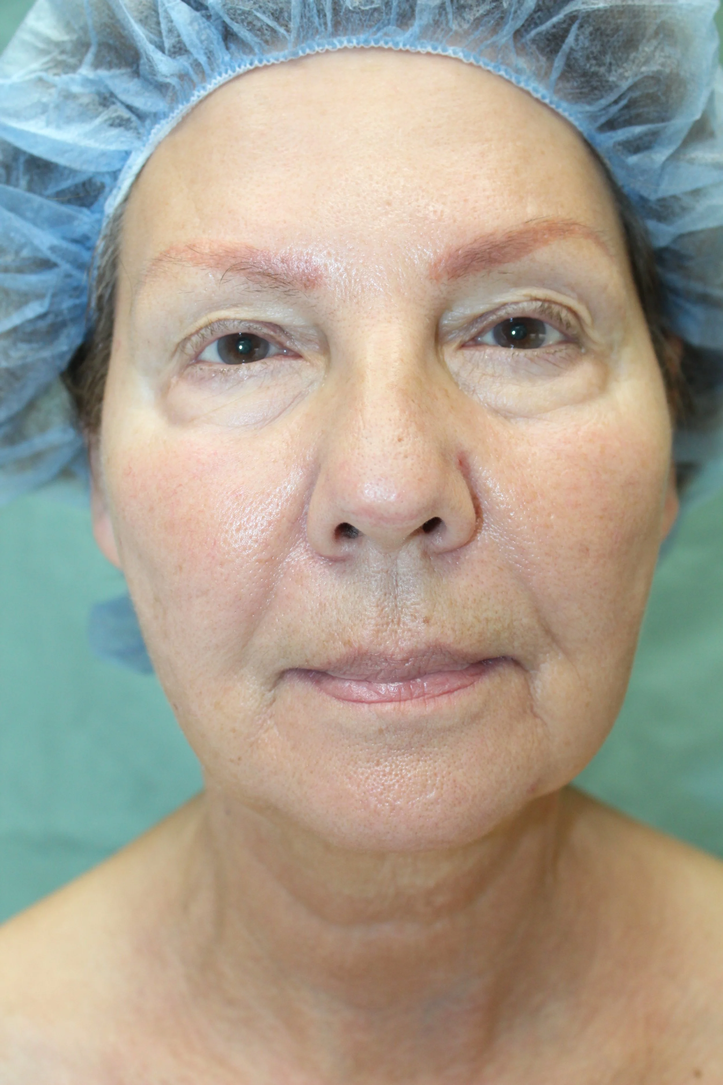 Patient Q - Pre-Operative Lower Eyelids and Facelift — Dr Giuffre Plastic Surgeon Edmonton
