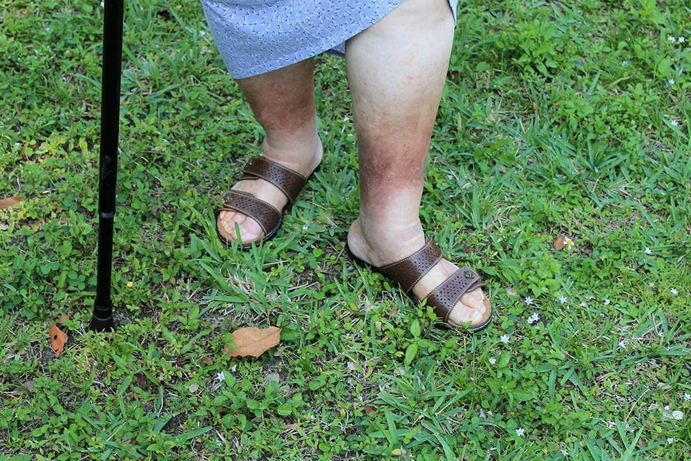 Peripheral Artery Disease Versus Peripheral Vascular Disease - MIMIT Health