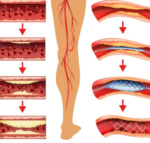 Blocked Artery Treatment | MIMIT Health