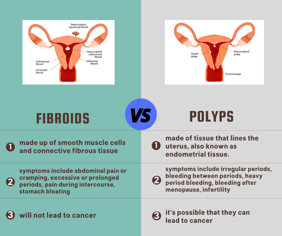 Uterine Fibroids: Symptoms, Diagnosis, Risk Factors & Treatment