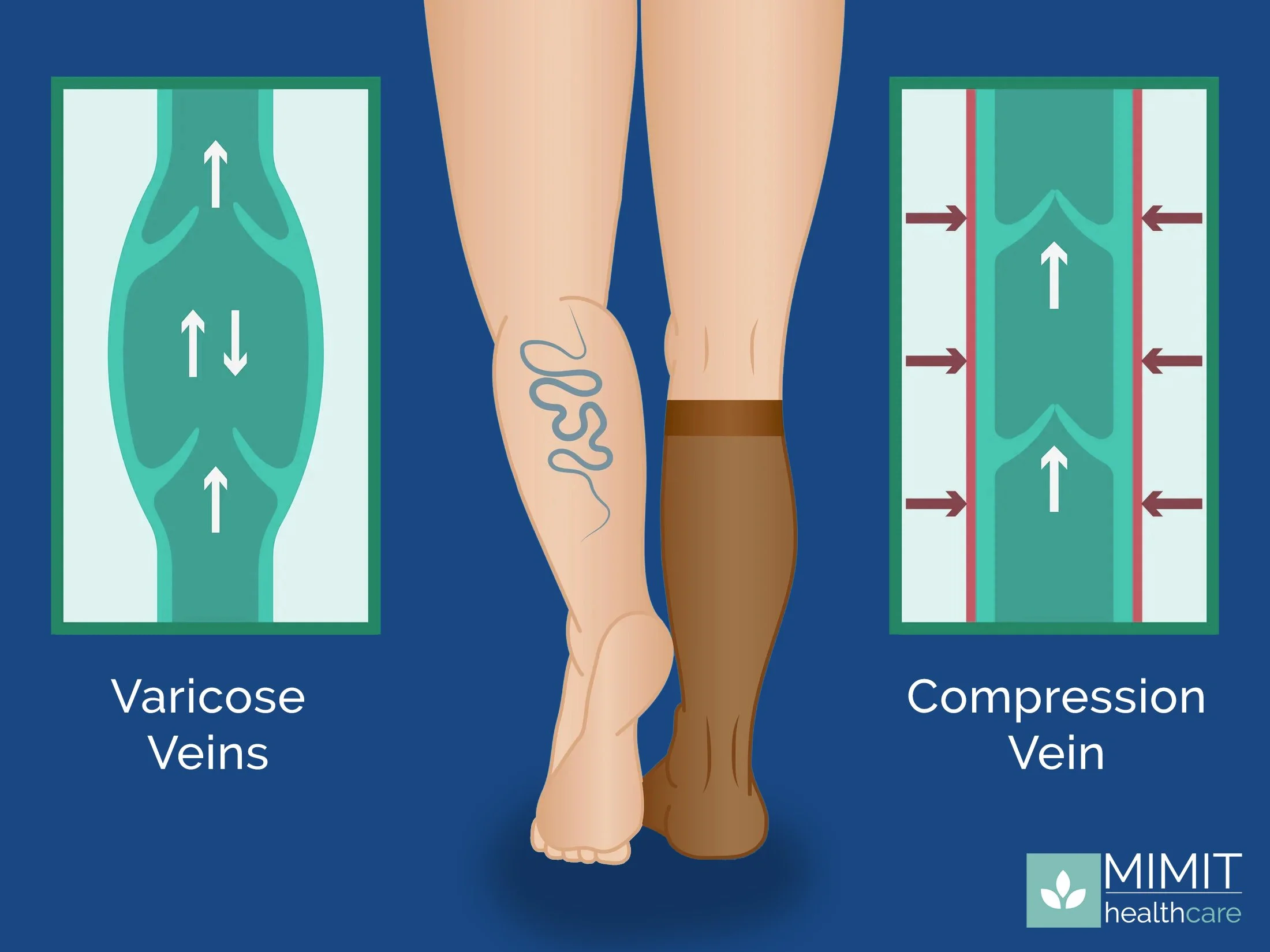 Varicose Veins: Symptoms, Risk Factors, Treatment | MIMIT Health