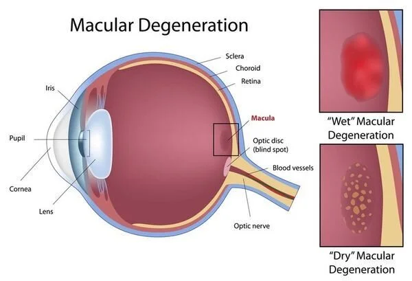 Retinal Diseases — EyeCare 20/20