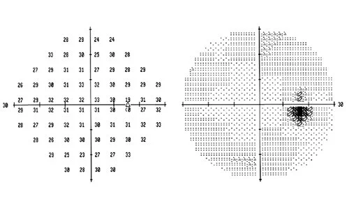 Visual Fields — RMOptical