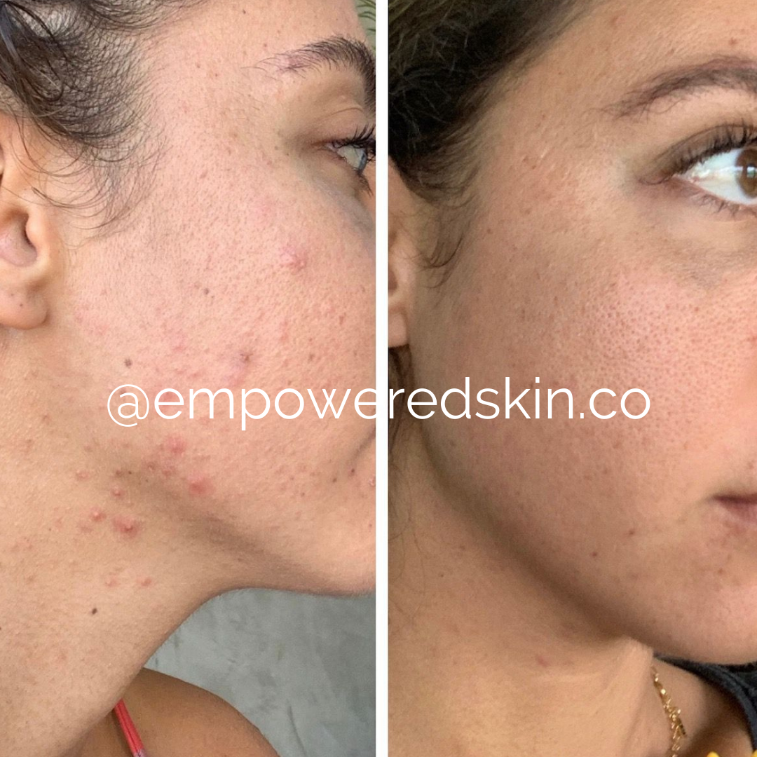 Best 3 Treatments For Acne — Empowered Skin