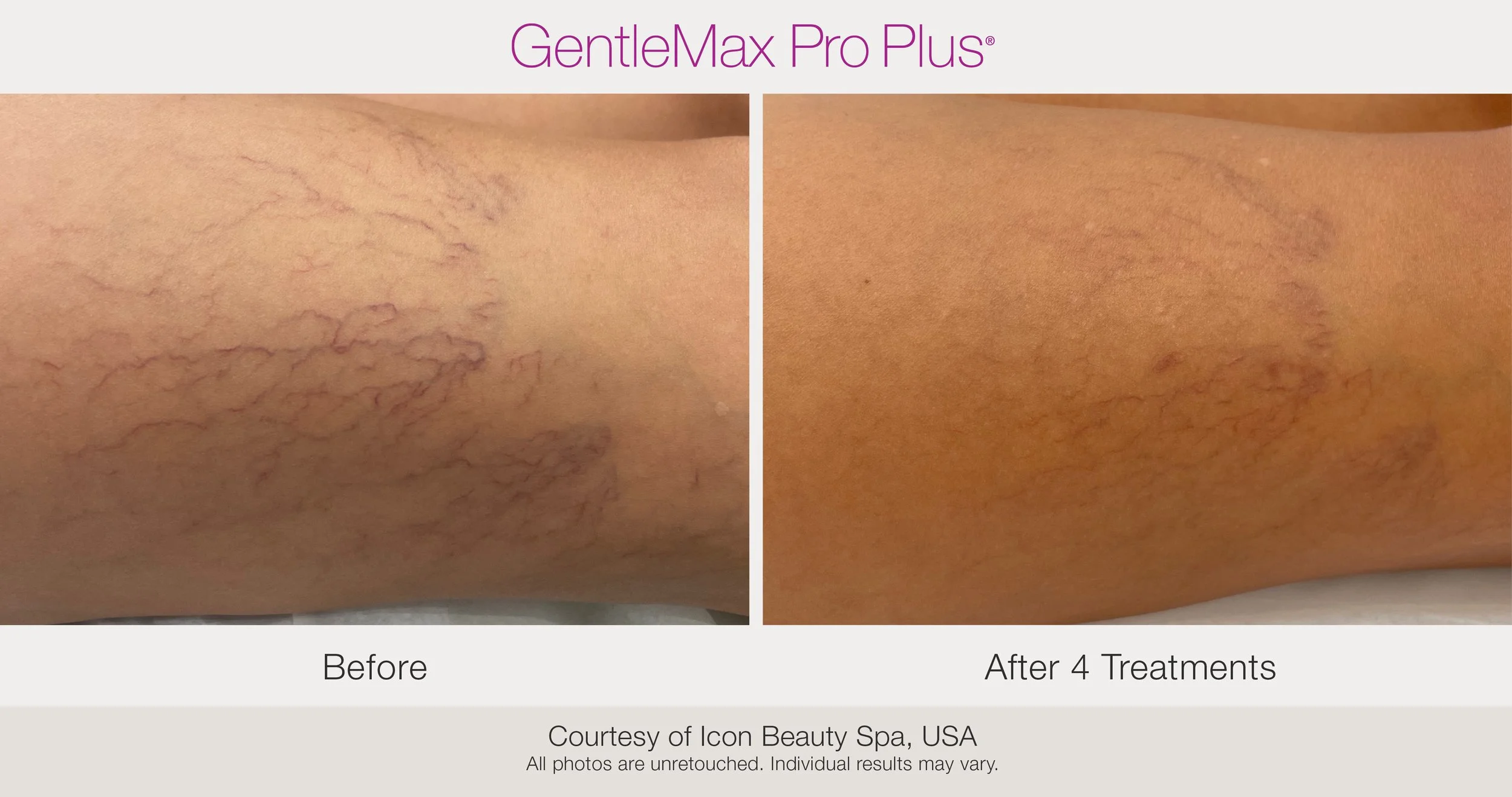 Vein Removal | CRAVE BEAUTY LAB