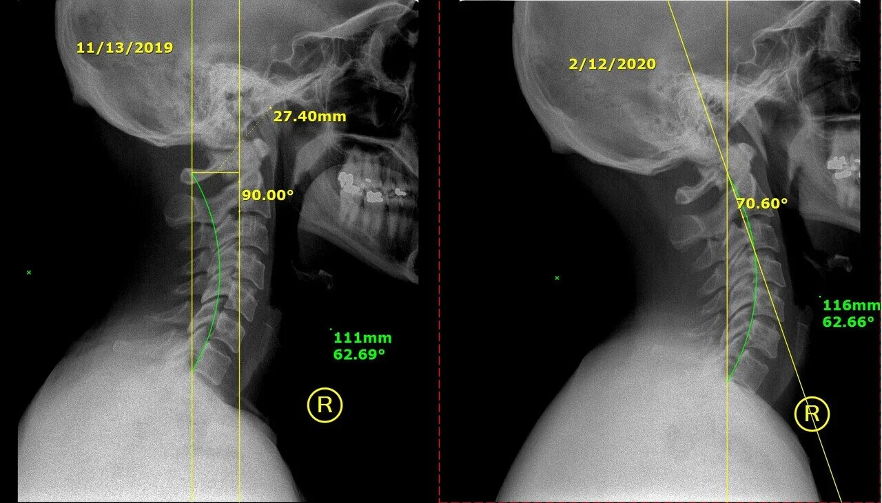 Before & After — Live Well Chiropractic