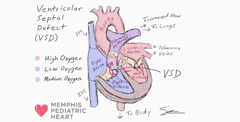 Ventricular Septal Defect — Pediatric Cardiologist - Pediatric Heart ...