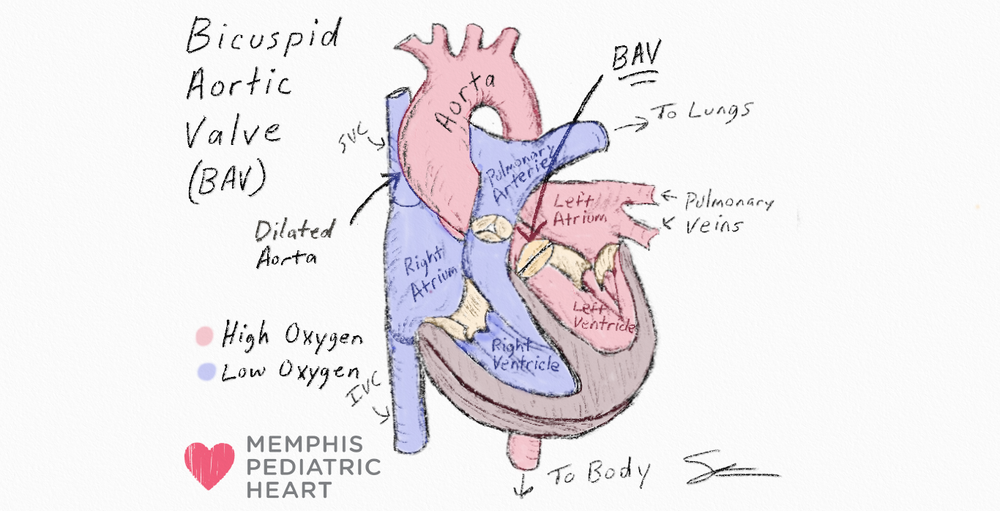 Bicuspid Aortic Valve — Pediatric Cardiologist - Pediatric Heart ...