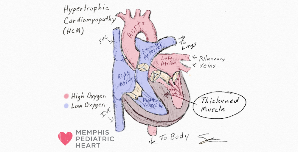 Hypertrophic Cardiomyopathy — Pediatric Cardiologist - Pediatric Heart ...