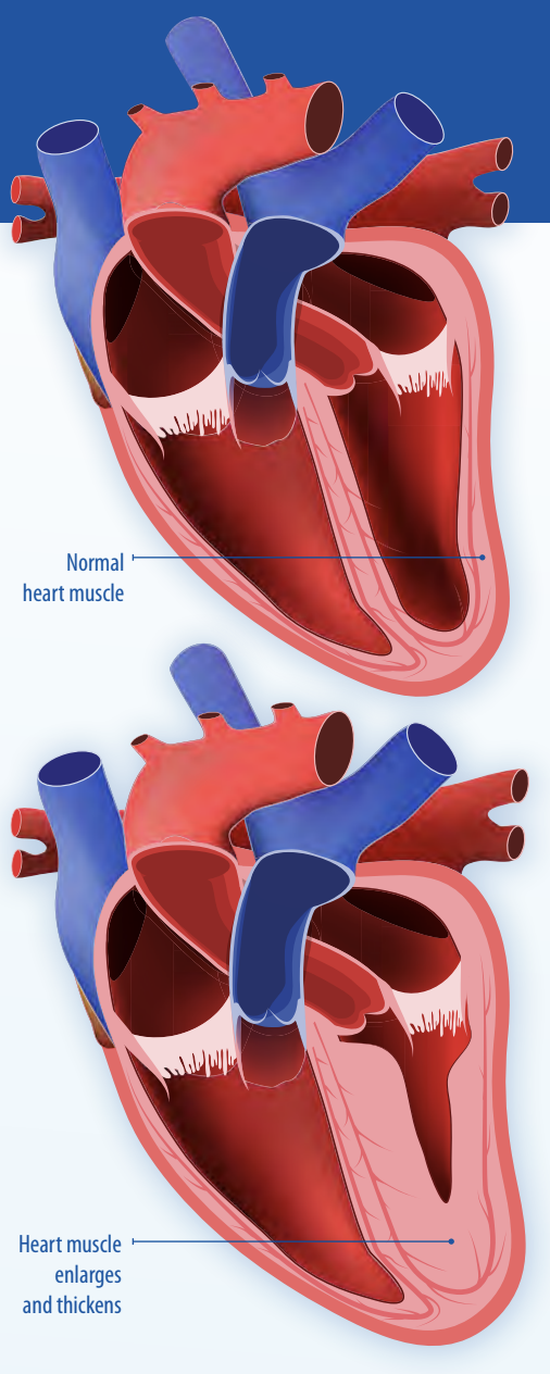 All About Hypertrophic Cardiomyopathy (HCM) — Community Health Clinic