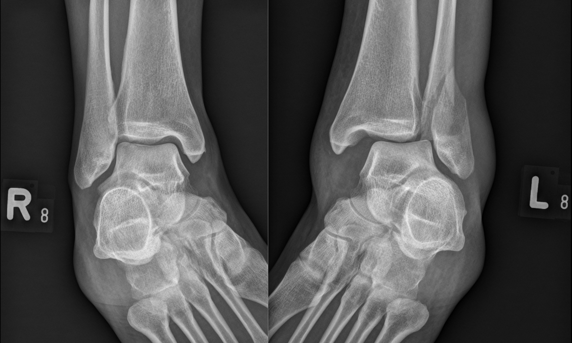 Skręciłem kostkę - zerwałem więzadło? — Radiologicznie.pl