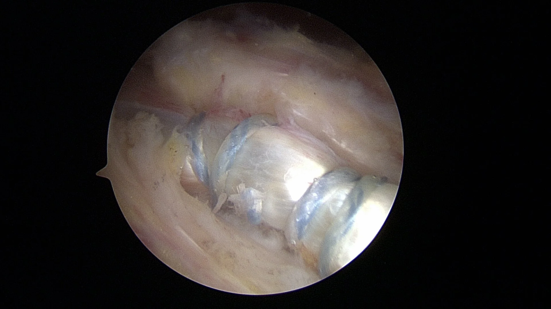 Shoulder surgical biceps tenodesis — KEVIN PARVARESH, MD