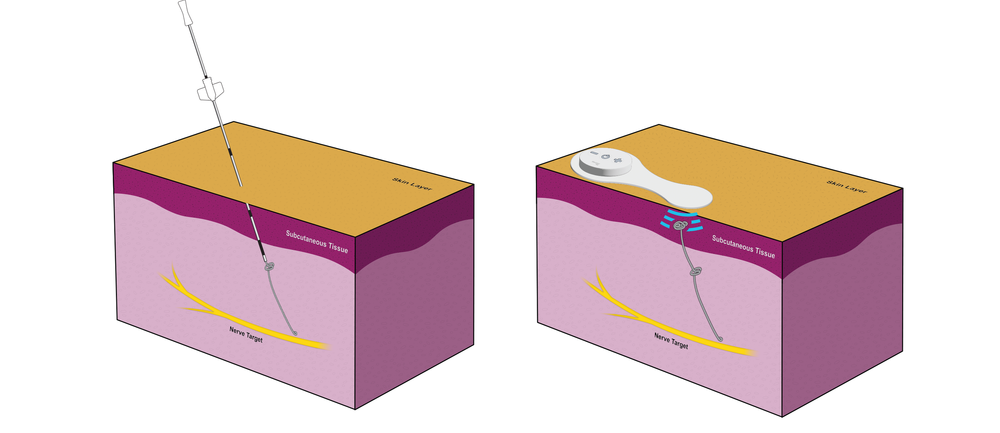 Neuromodulation Overview — Relief Simplified | Neuronoff