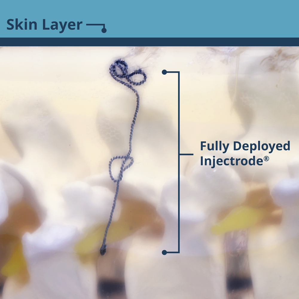 Injectrode — Relief Simplified | Neuronoff