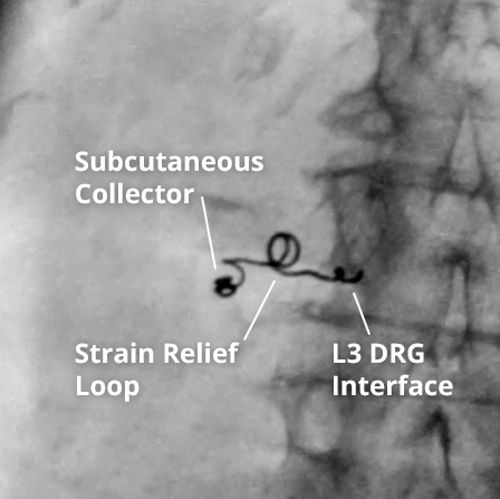 Injectrode — Relief Simplified | Neuronoff