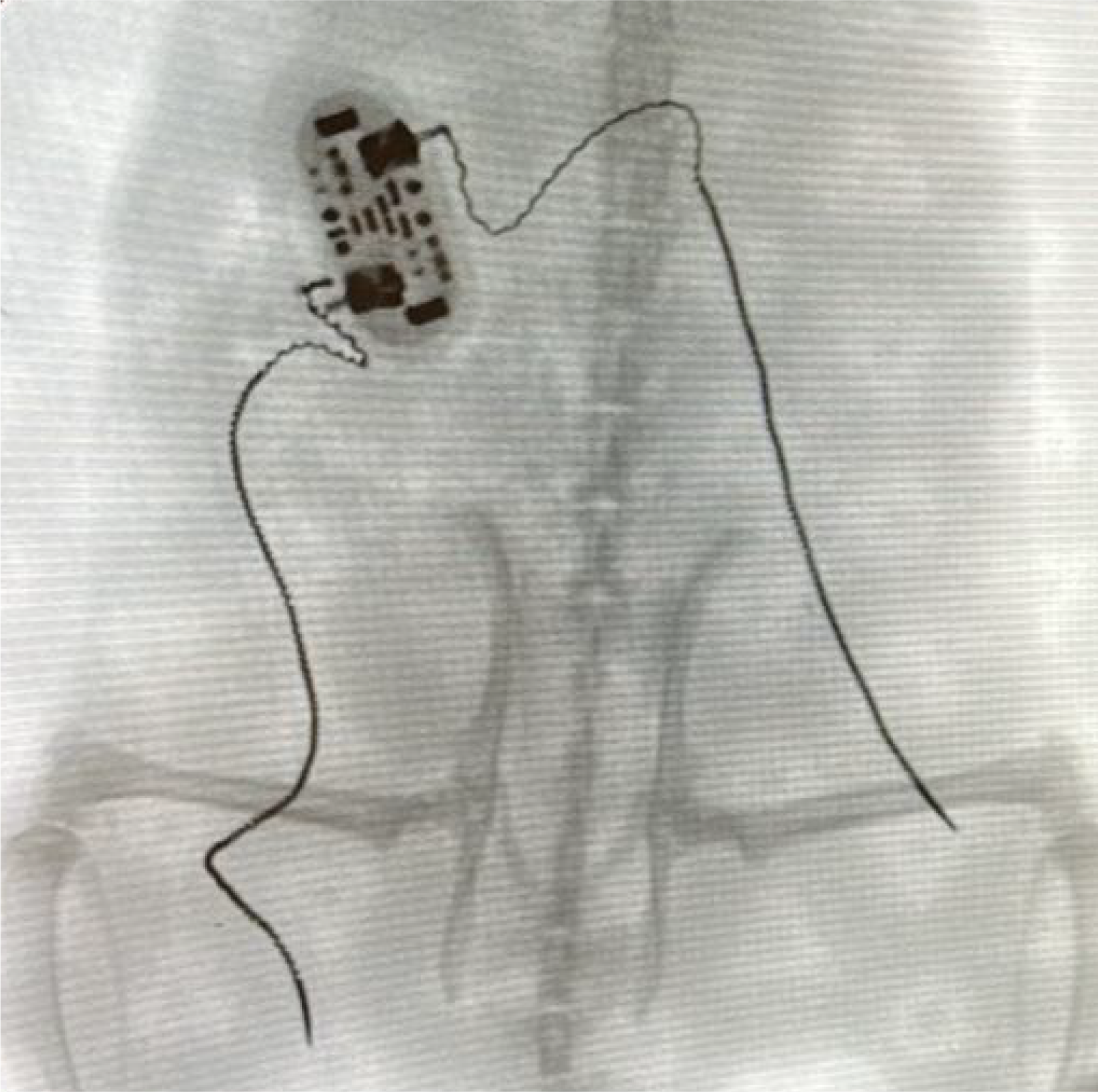 IPG, Receiver & Adapter — Relief Simplified | Neuronoff
