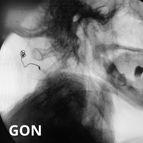 Injectrode — Relief Simplified | Neuronoff