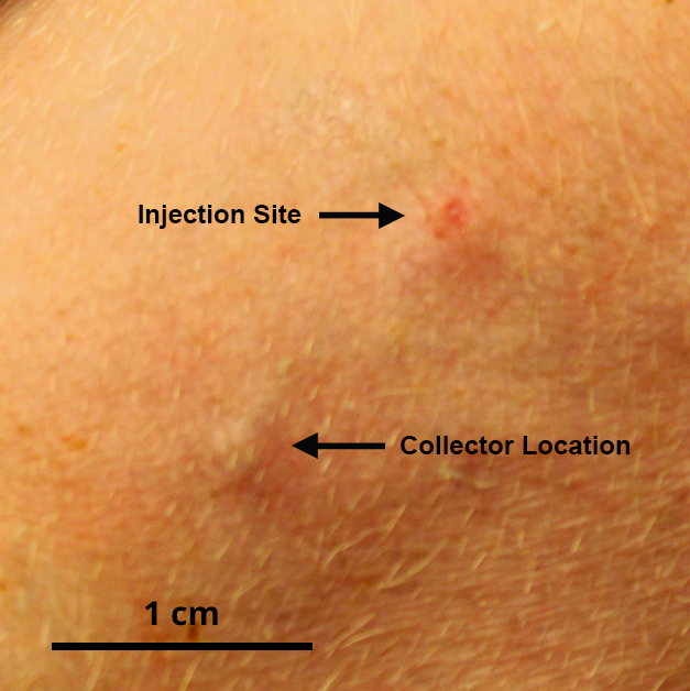 Injectrode — Relief Simplified | Neuronoff