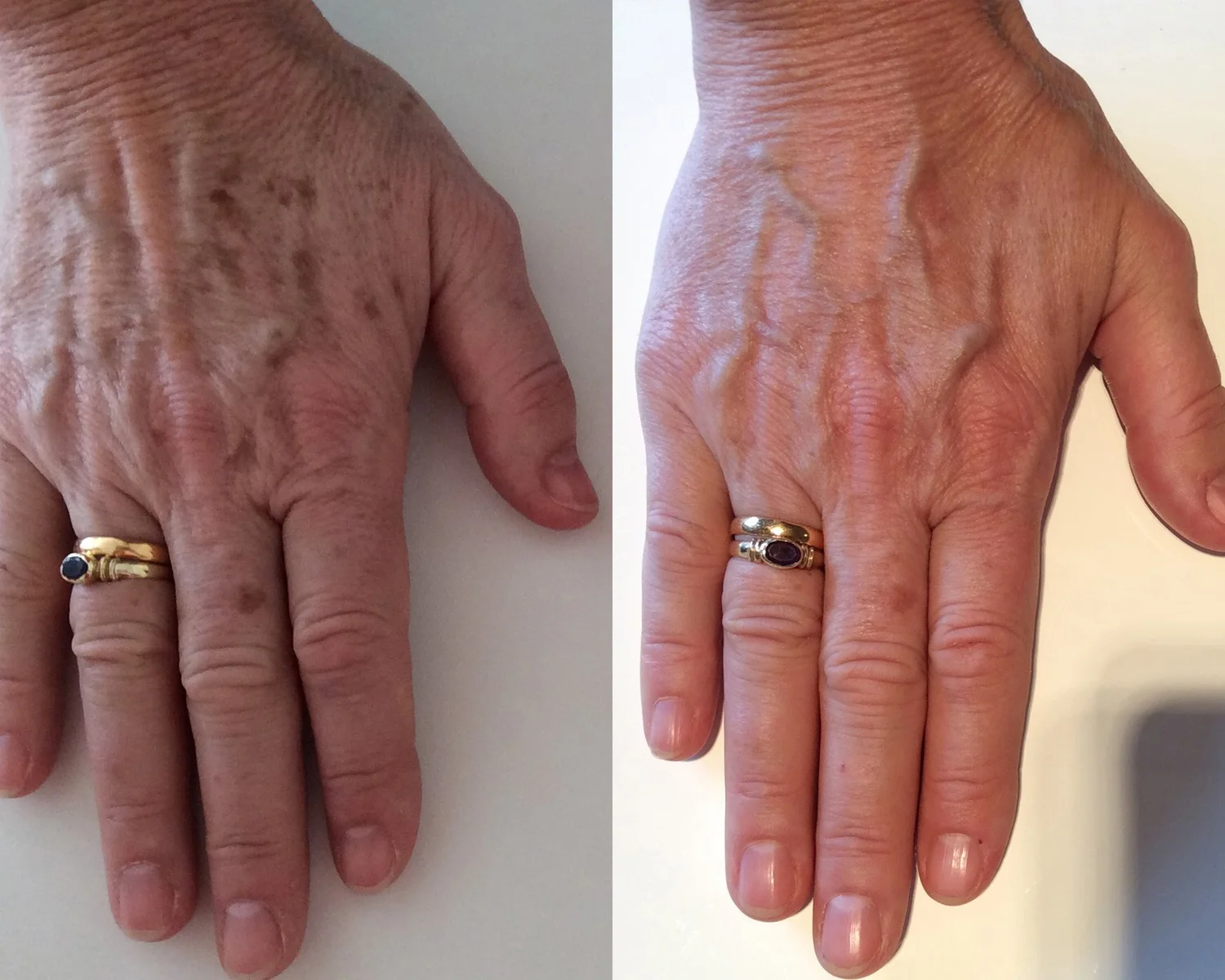 How does Lumecca IPL help my skin and other FAQs — Park Medical ...