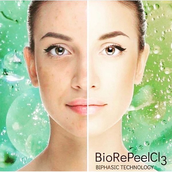 BioRePeel treatment $195 special bergen county NJ - MY Skin Care Center NJ