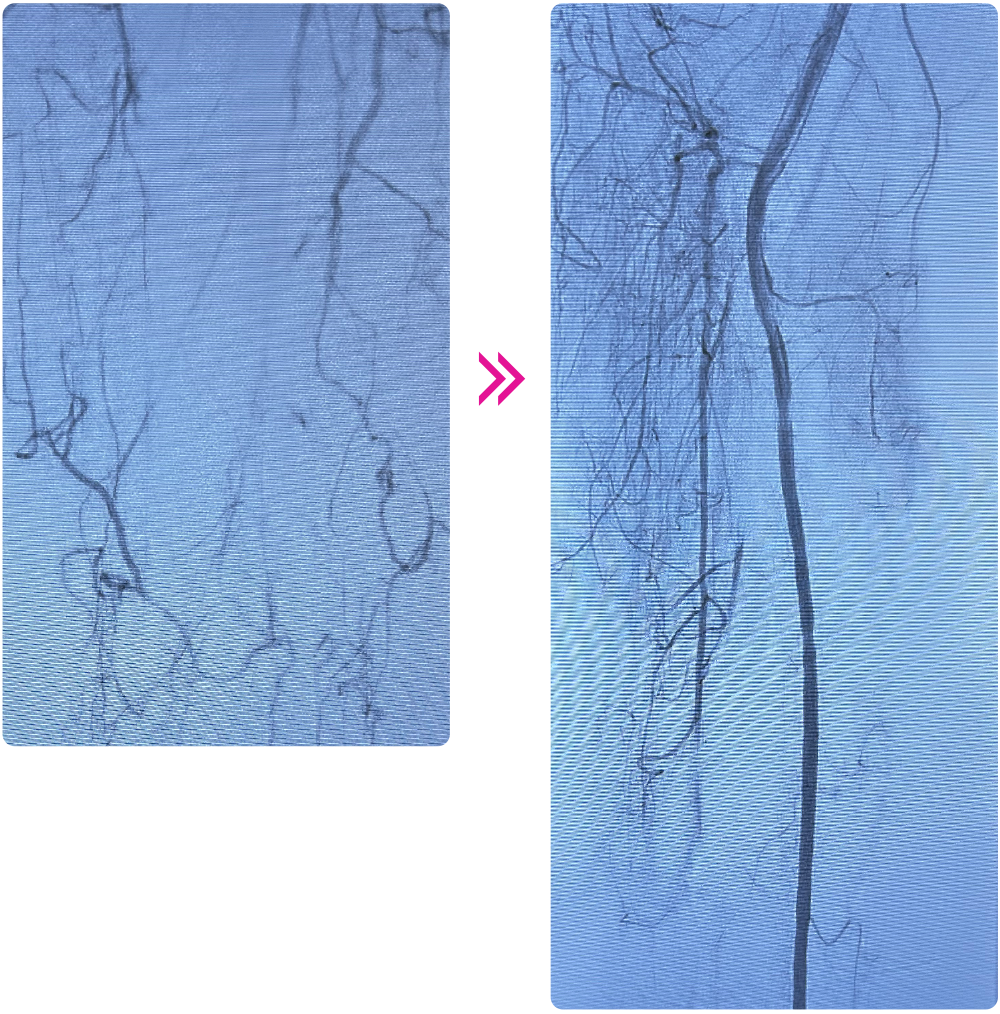 Interventional Products — Surmodics, Inc.