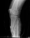 Understanding Bone Fractures — Science of Falling