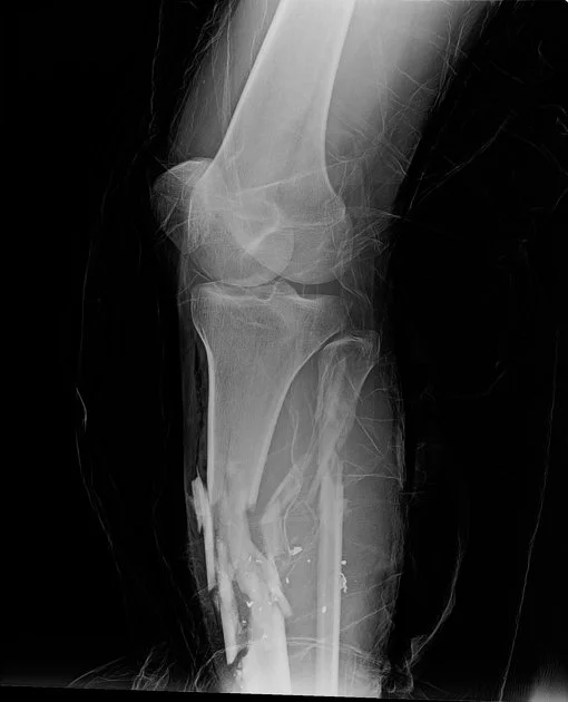 Understanding Bone Fractures — Science of Falling